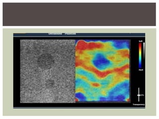 Ultrasound Elastography: Principles, techniques & clinical applications ...