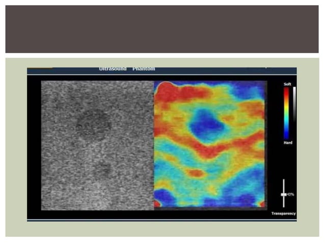 Ultrasound Elastography: Principles, techniques & clinical applications ...