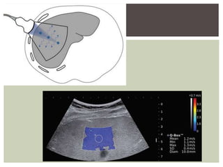 Ultrasound Elastography: Principles, techniques & clinical applications ...