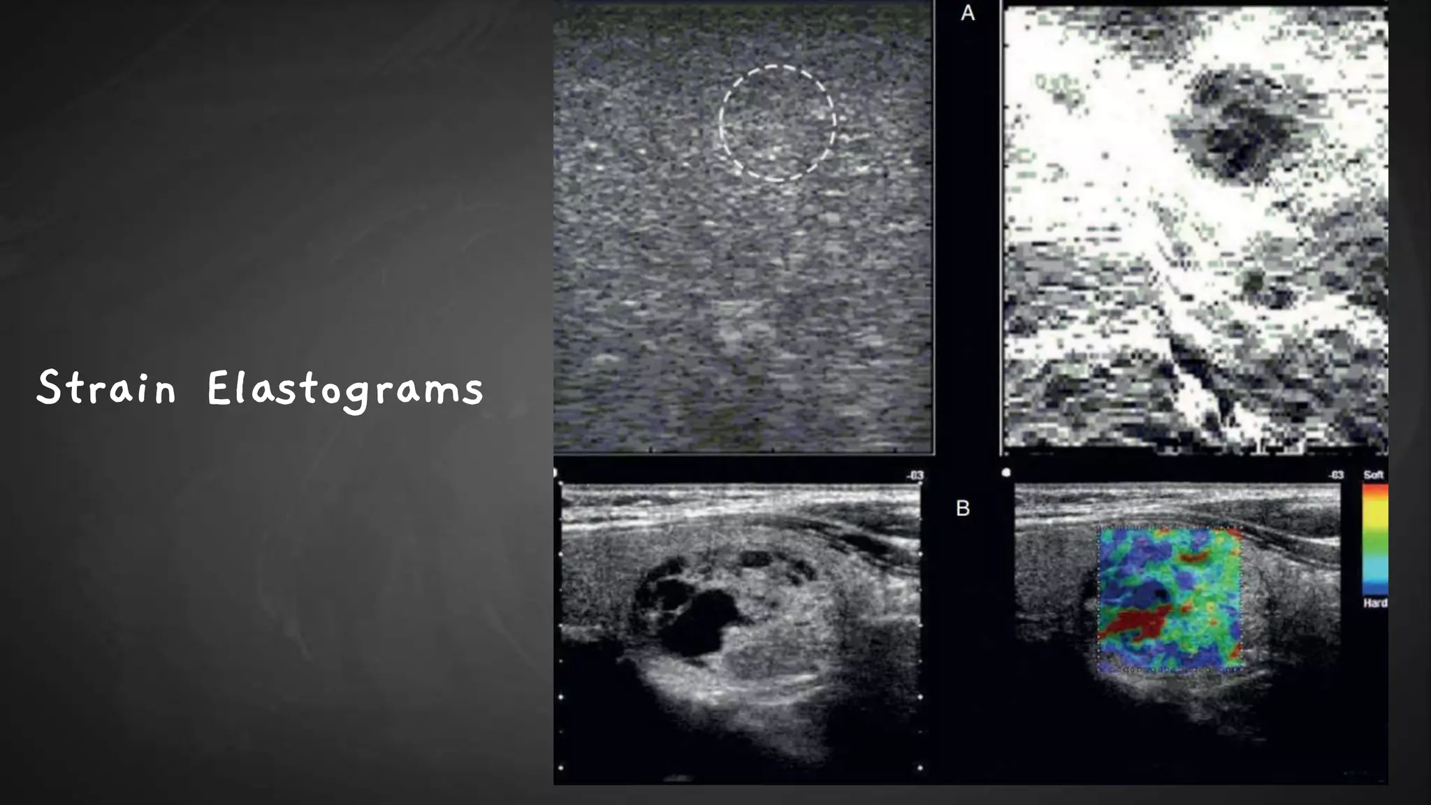 Ultrasound elastography | PPTX