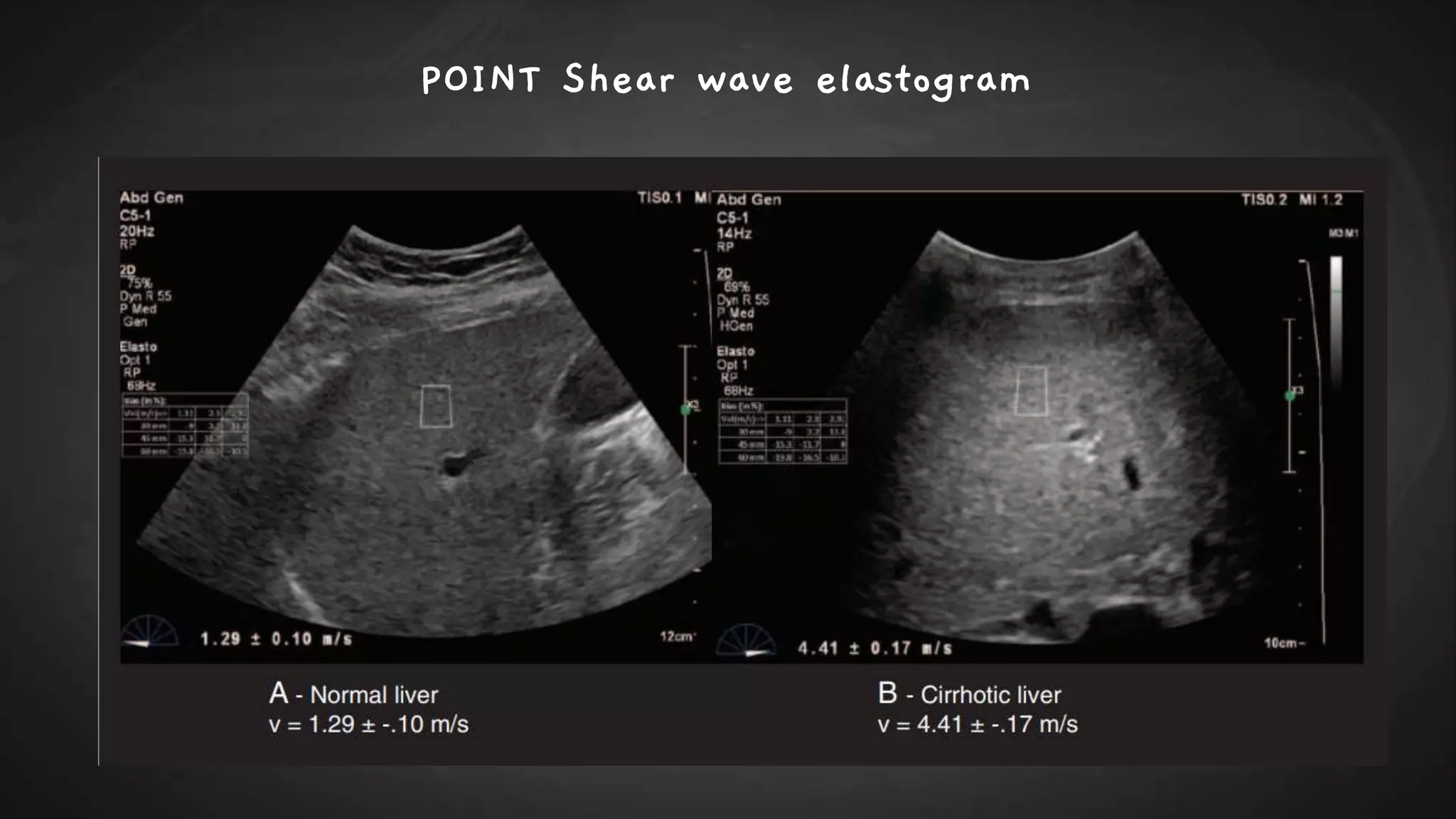 Ultrasound elastography | PPTX