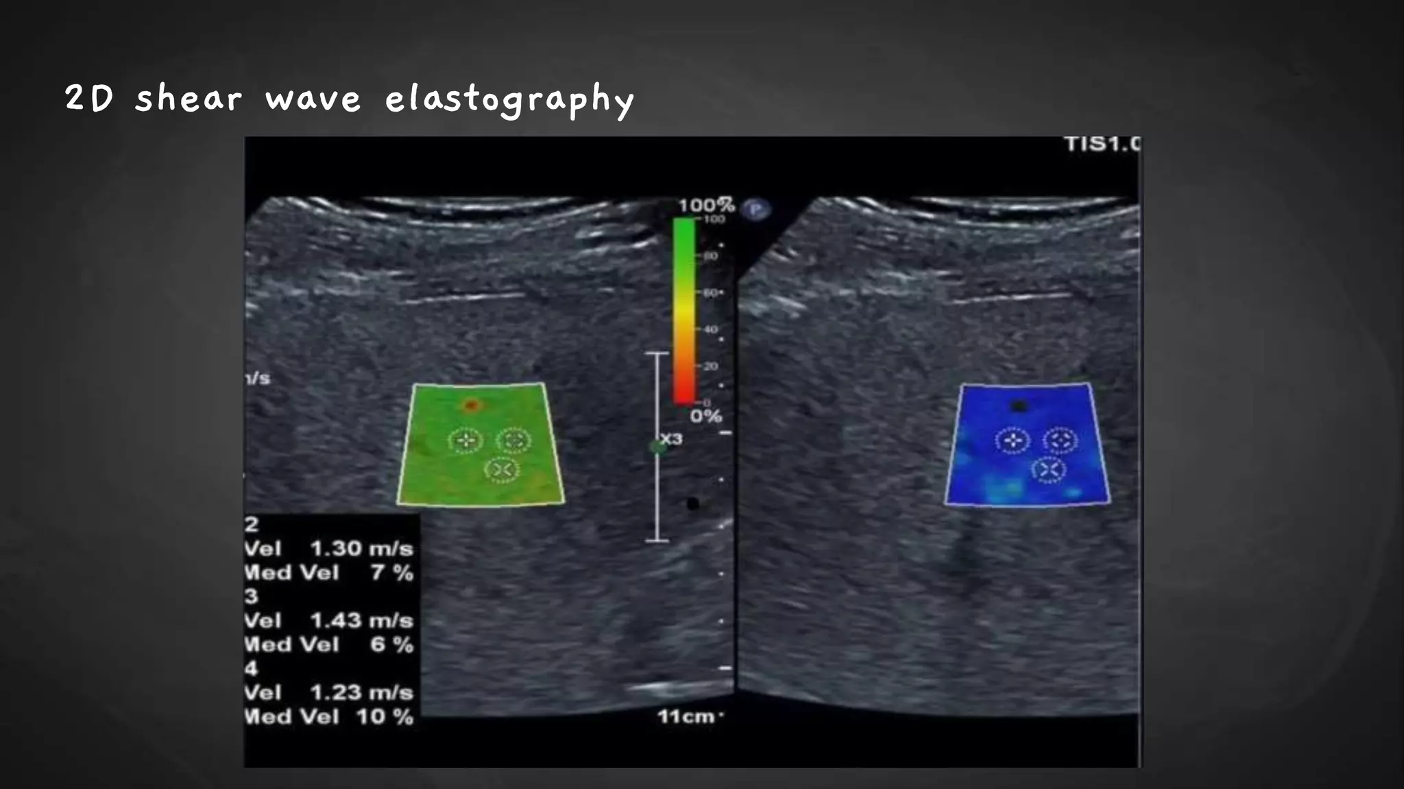 Ultrasound elastography | PPTX