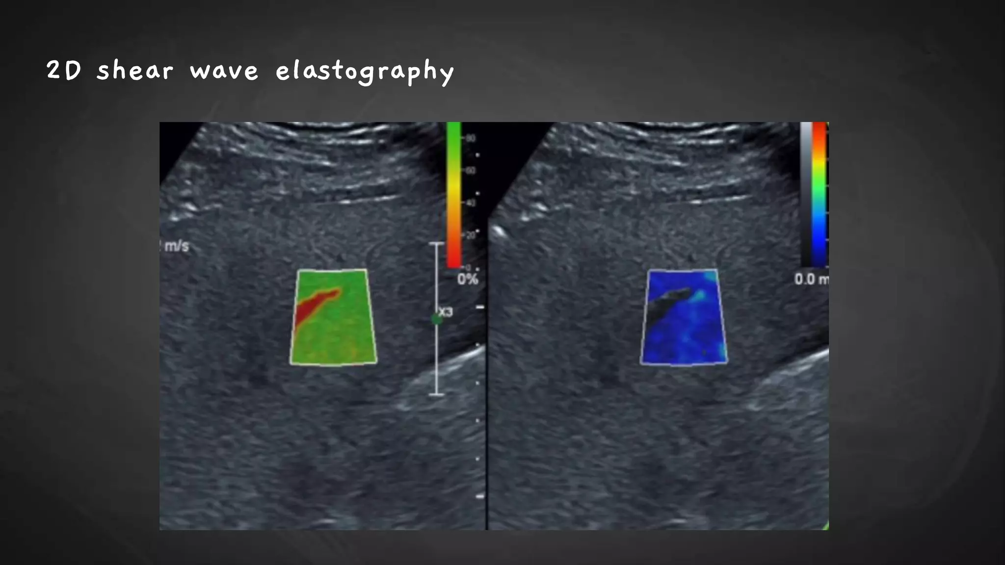 Ultrasound elastography | PPTX
