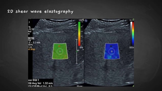 Ultrasound elastography | PPTX | Physics | Science