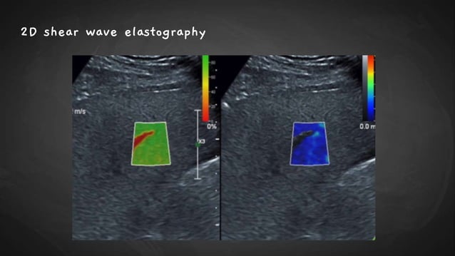 Ultrasound elastography | PPTX | Physics | Science