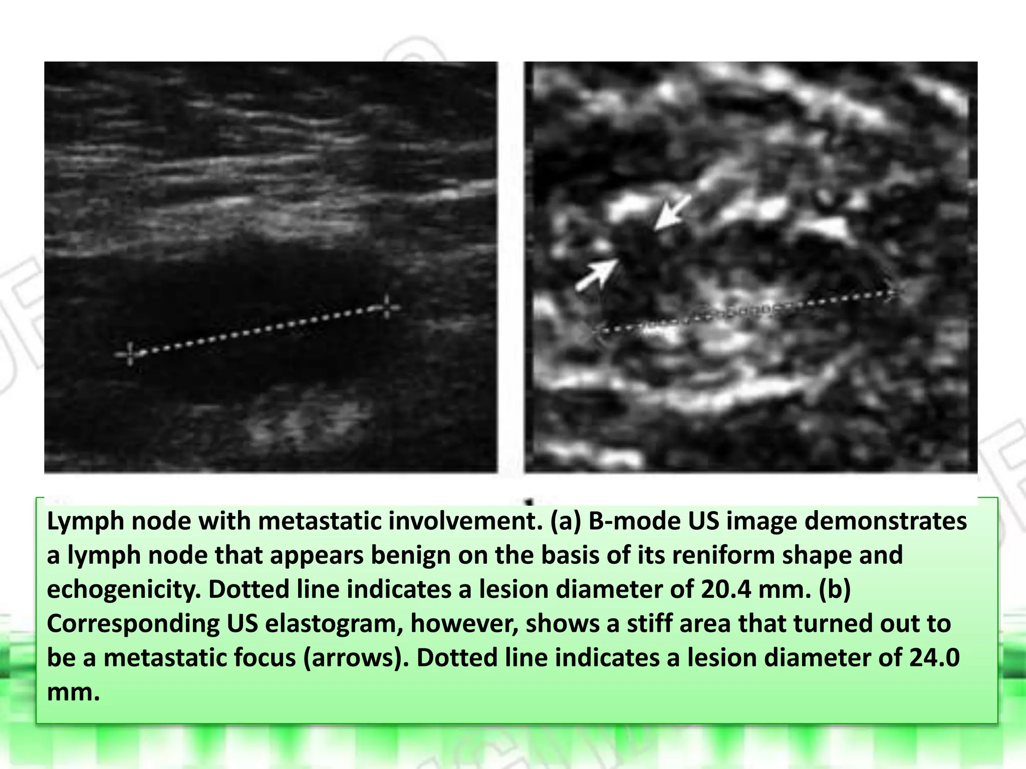 Ultrasound elastography of breast and prostate lesions | PPTX