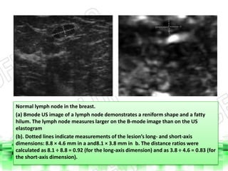 Ultrasound elastography of breast and prostate lesions | PPTX