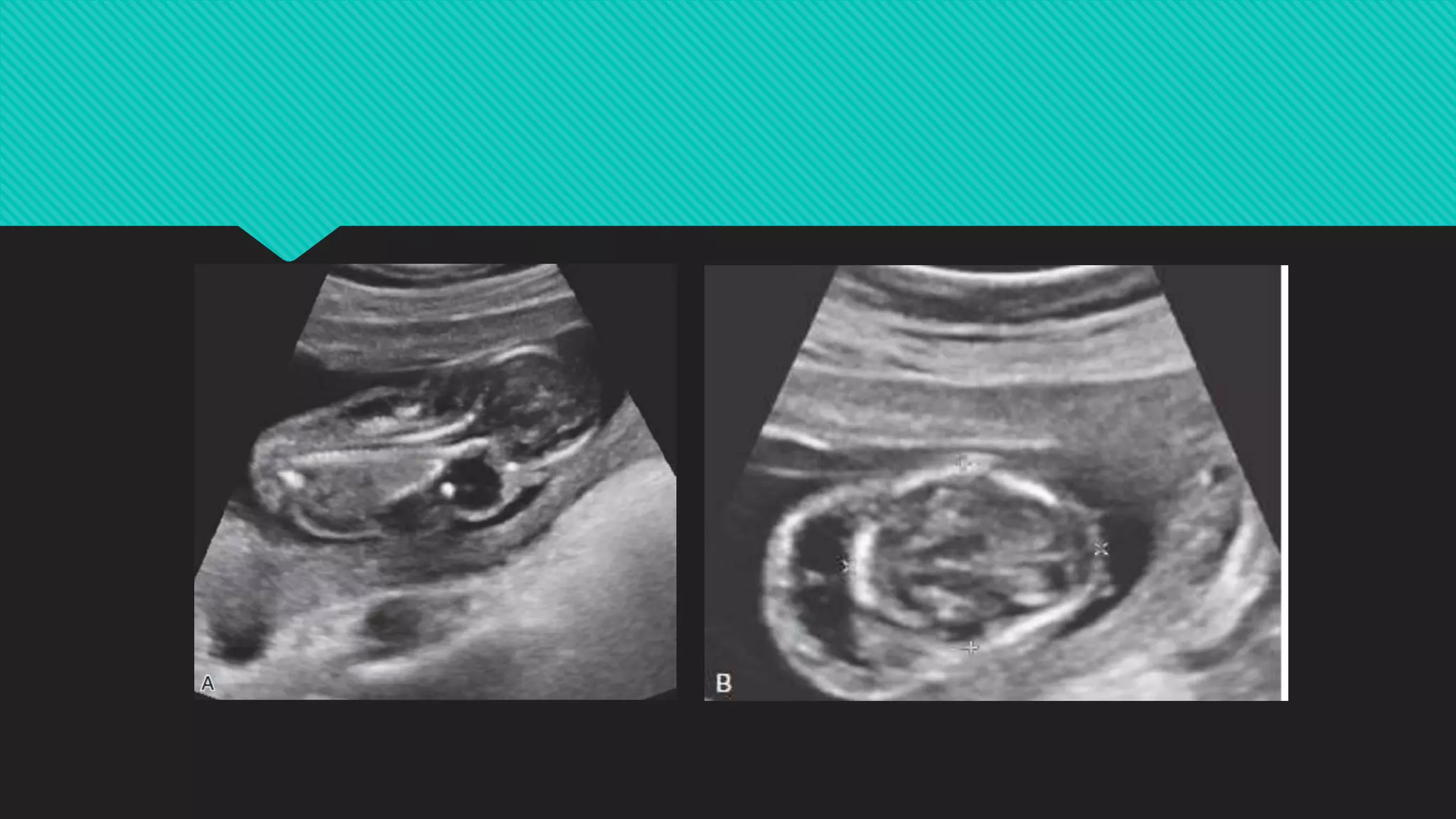 ULTRASOUND EVALUATION OF ANEUPLOIDY IN FIRST AND SECOND TRIMESTER | PPTX