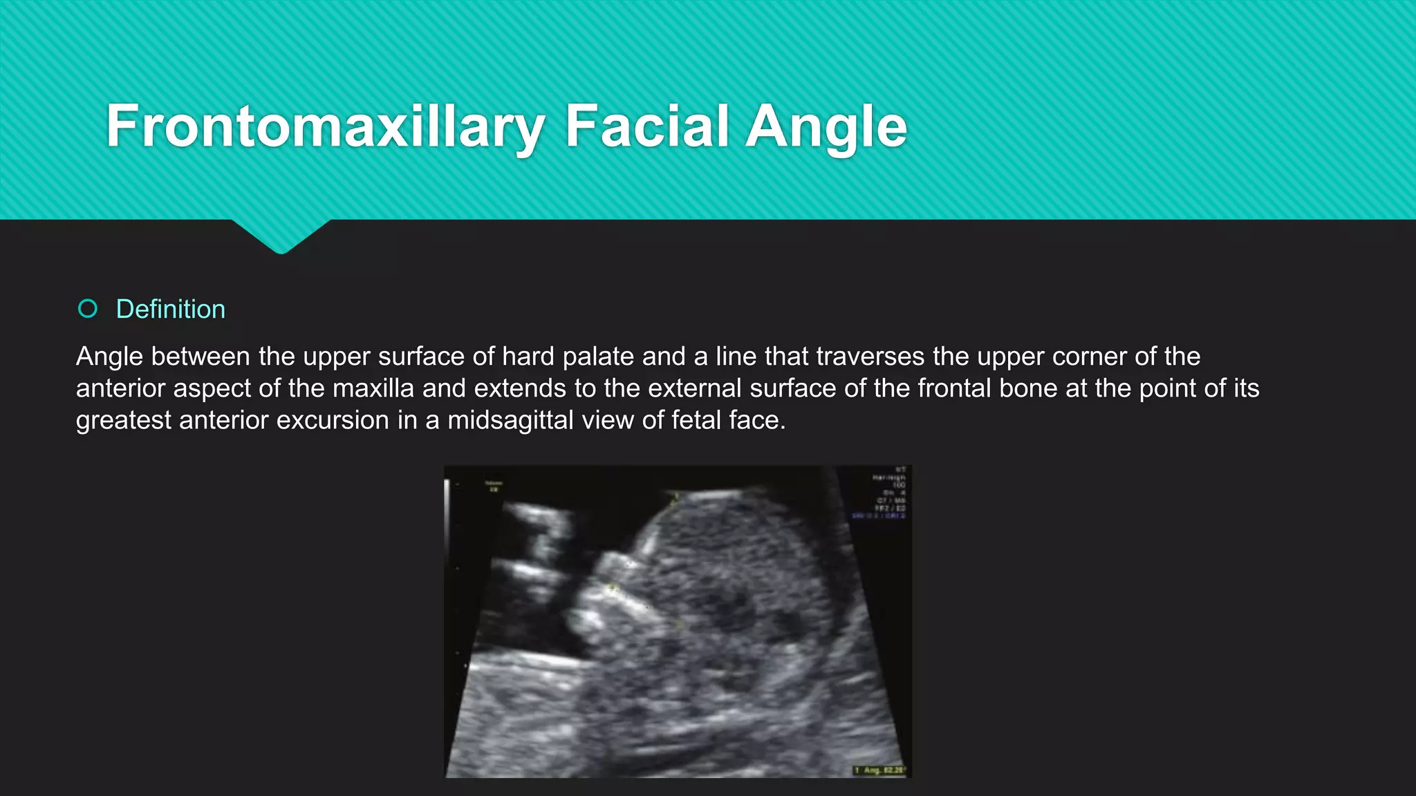 ULTRASOUND EVALUATION OF ANEUPLOIDY IN FIRST AND SECOND TRIMESTER | PPTX