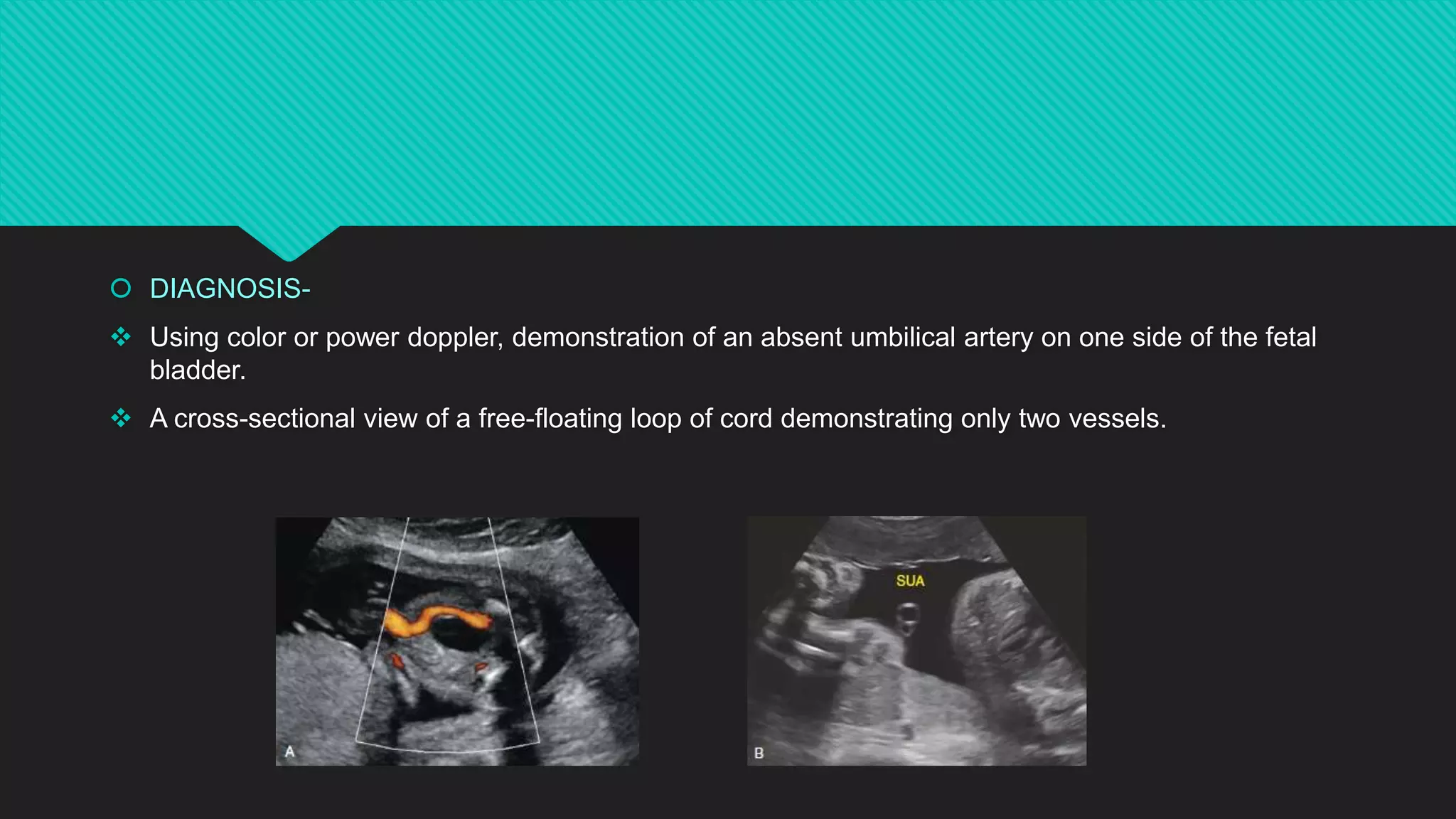 ULTRASOUND EVALUATION OF ANEUPLOIDY IN FIRST AND SECOND TRIMESTER | PPTX