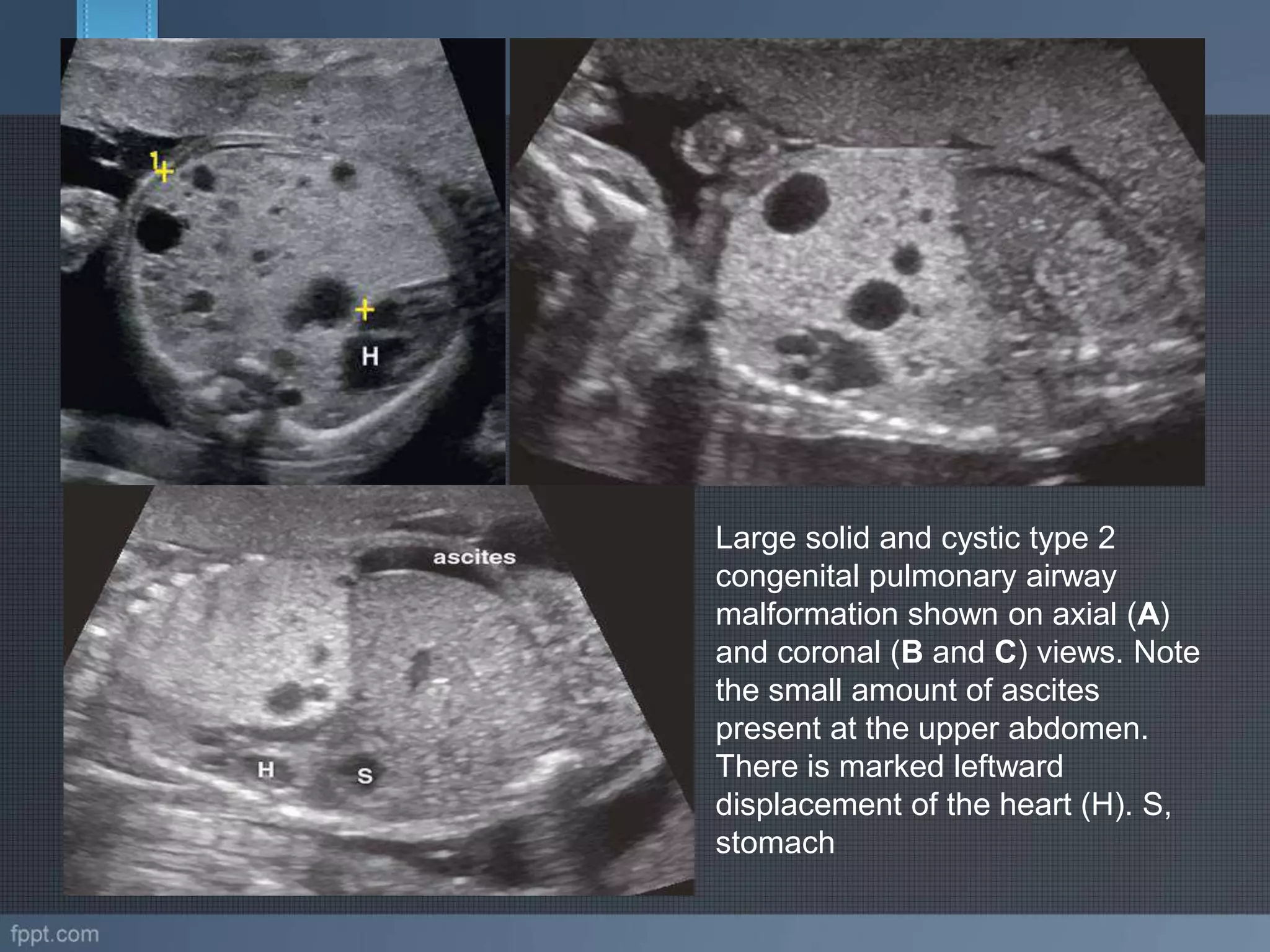 Ultrasound evaluation of fetal thorax | PPT