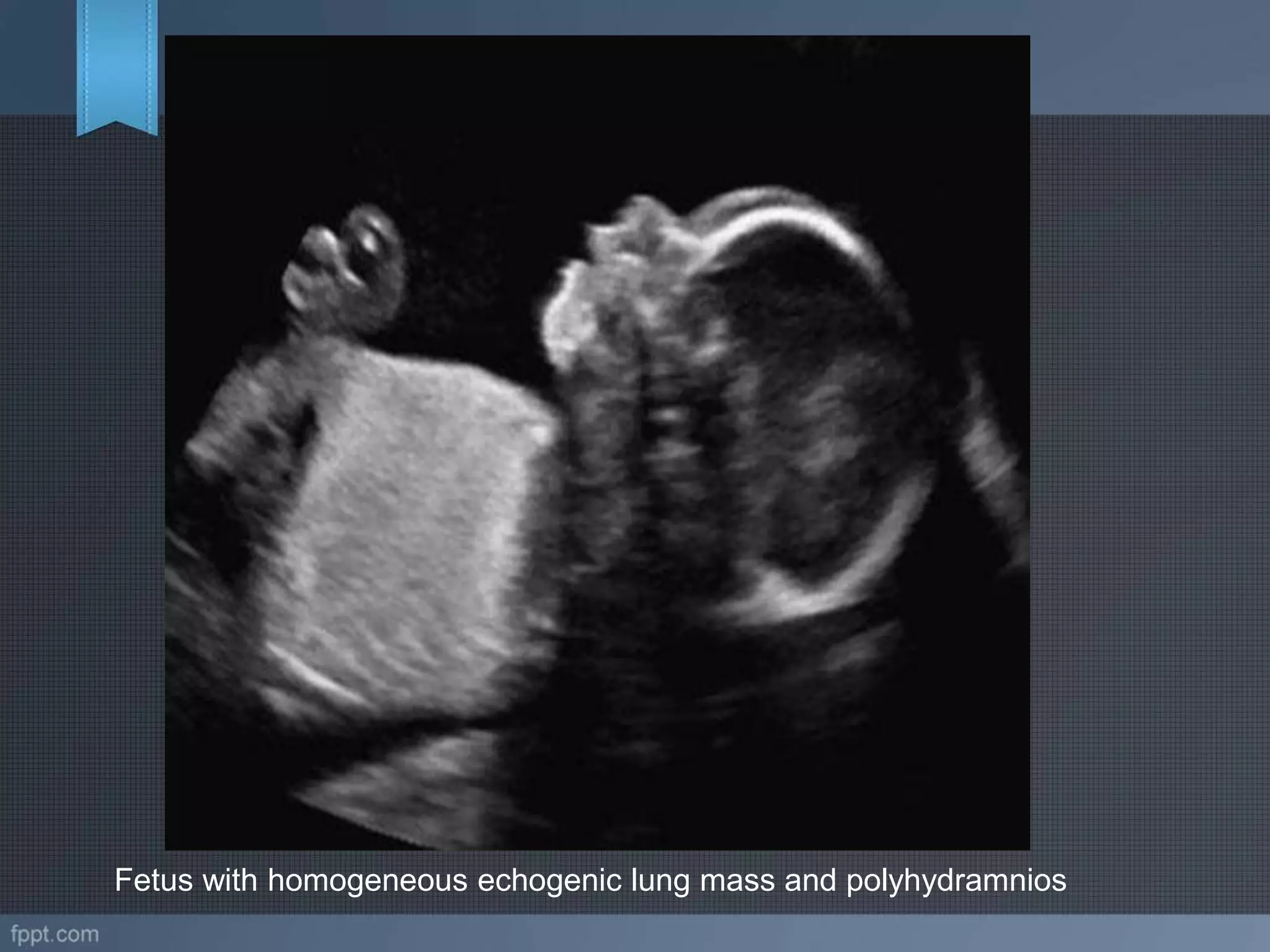 Ultrasound evaluation of fetal thorax | PPT