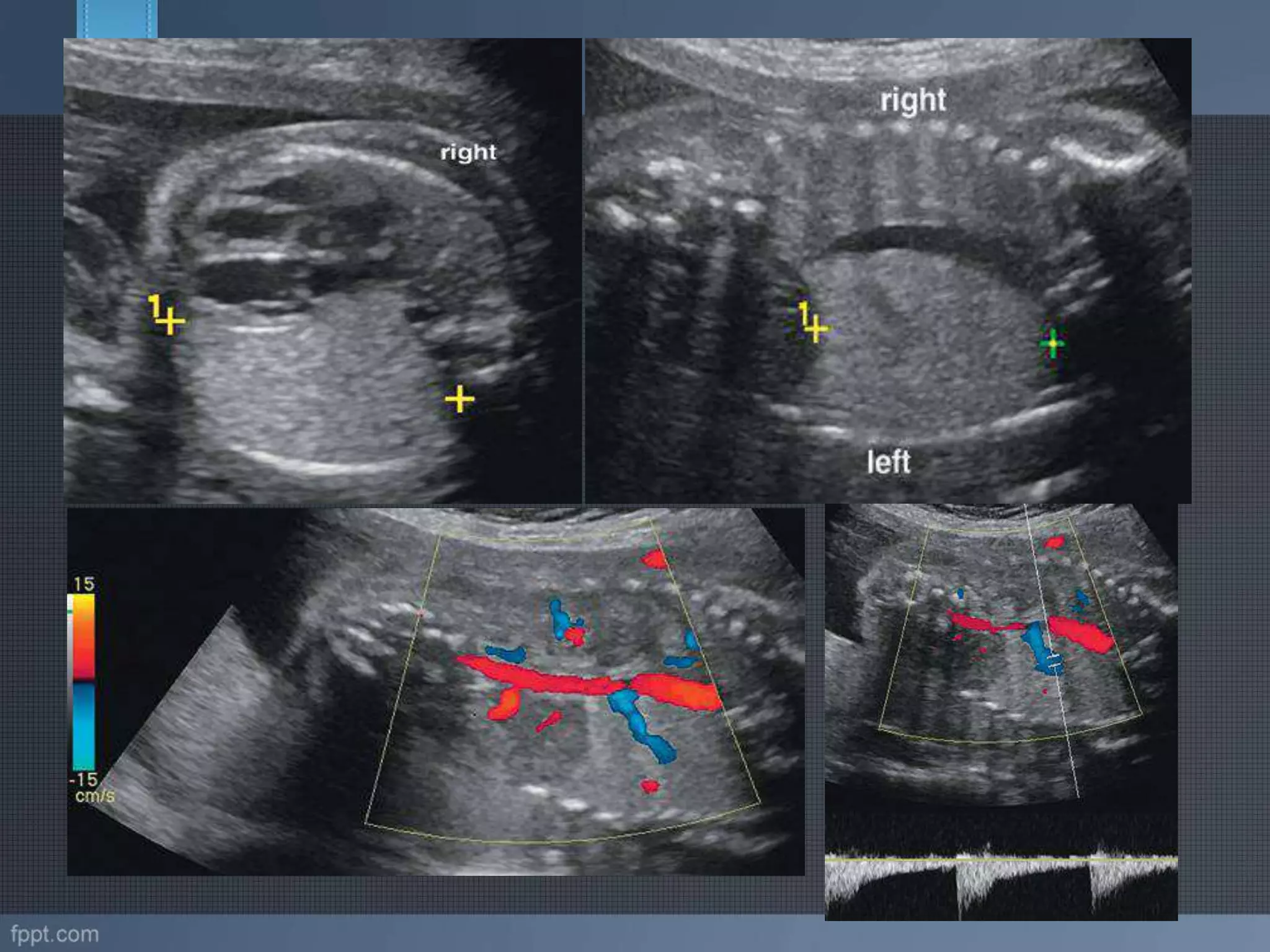 Ultrasound evaluation of fetal thorax | PPT