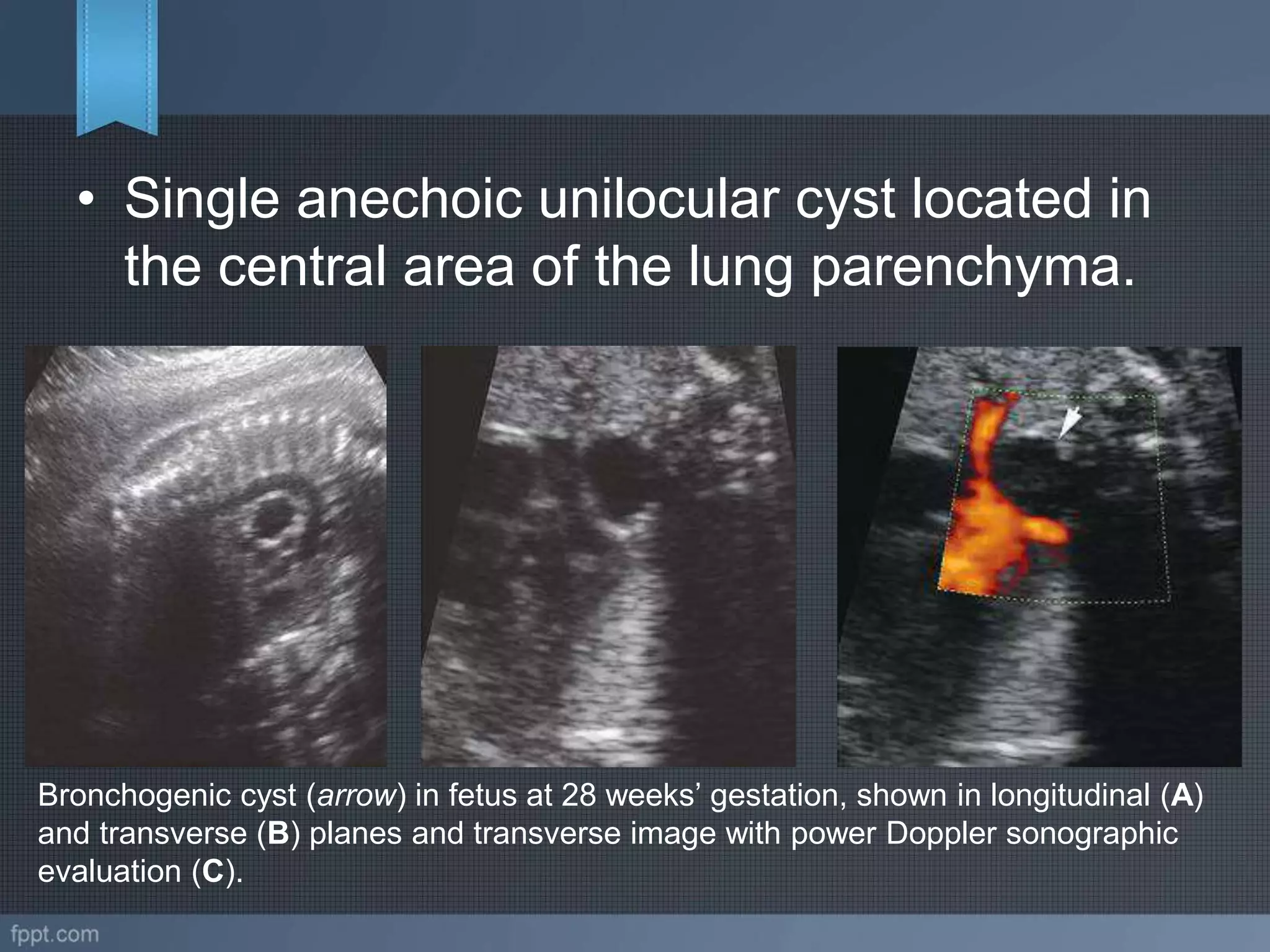 Ultrasound evaluation of fetal thorax | PPT