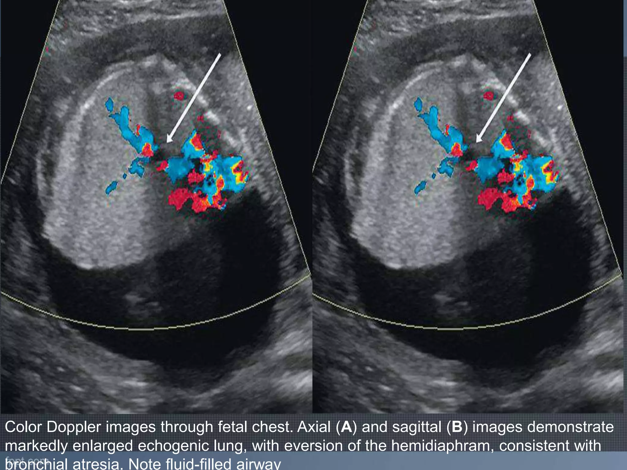 Ultrasound evaluation of fetal thorax | PPT