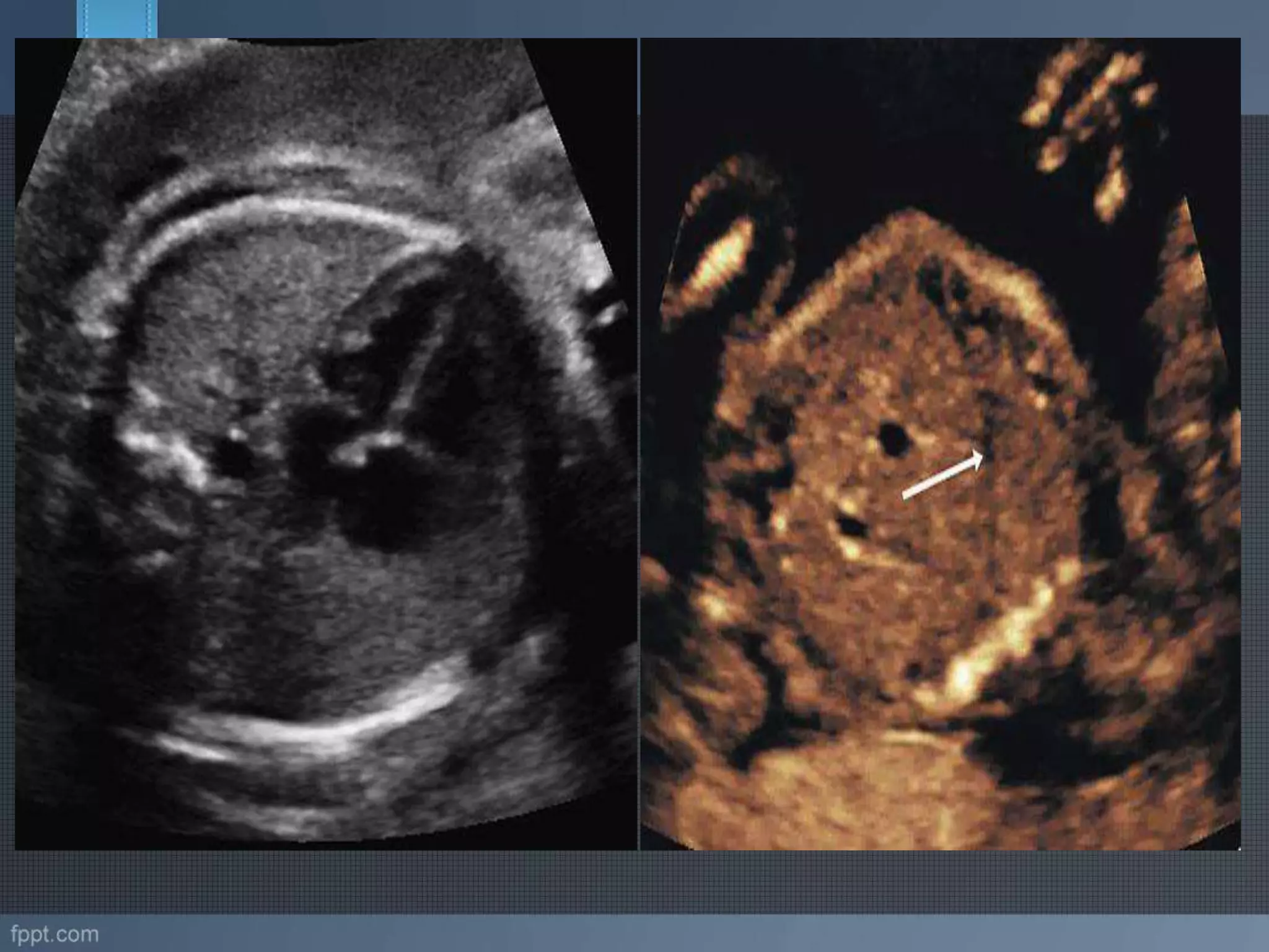 Ultrasound evaluation of fetal thorax | PPT