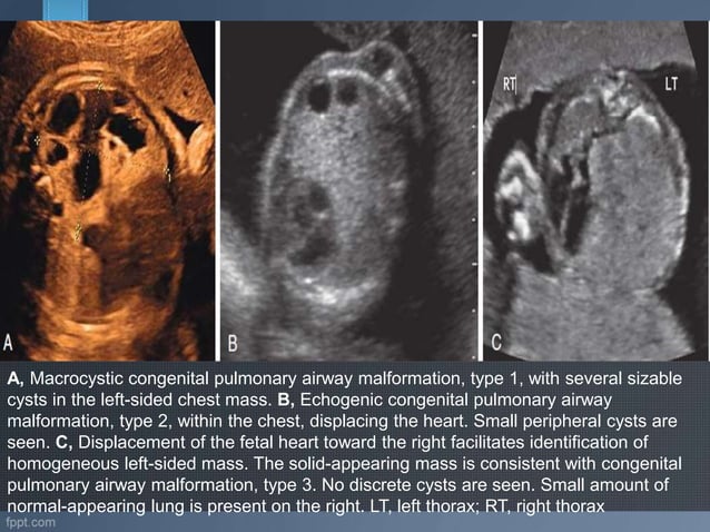 Ultrasound evaluation of fetal thorax | PPT