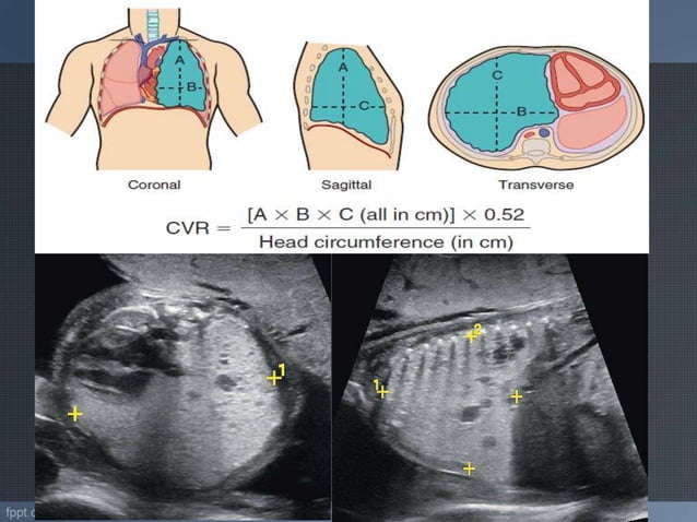 Ultrasound evaluation of fetal thorax | PPT