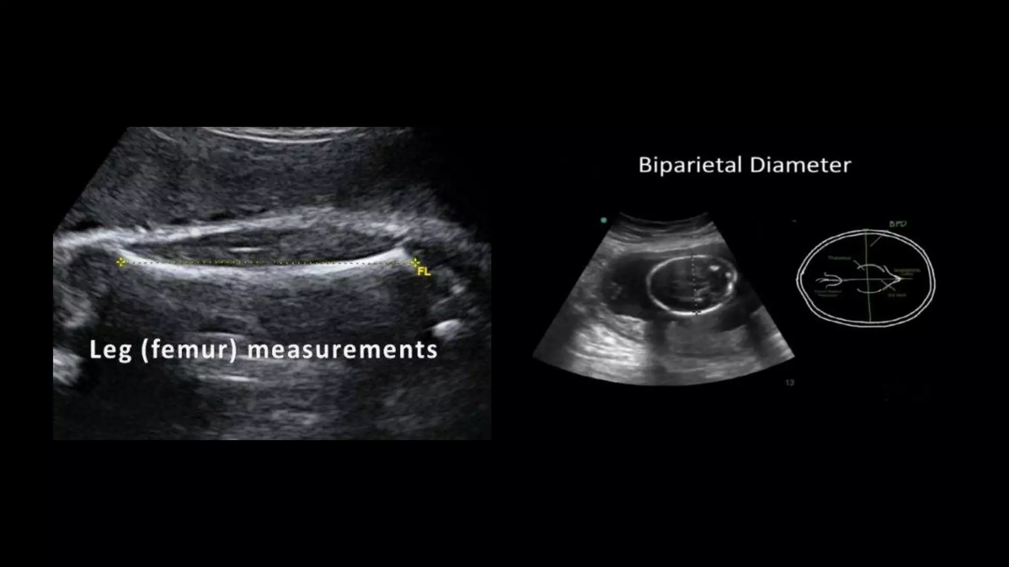 Ultrasound examination of the third trimester of pregnancy | PPTX