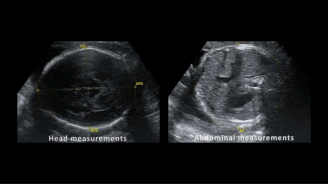 Ultrasound examination of the third trimester of pregnancy