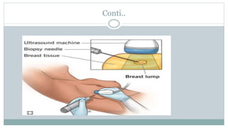 ULTRASOUND GUIDED BREAST BIOPSY.pptx,o know the nature of lesion. Cyst ...