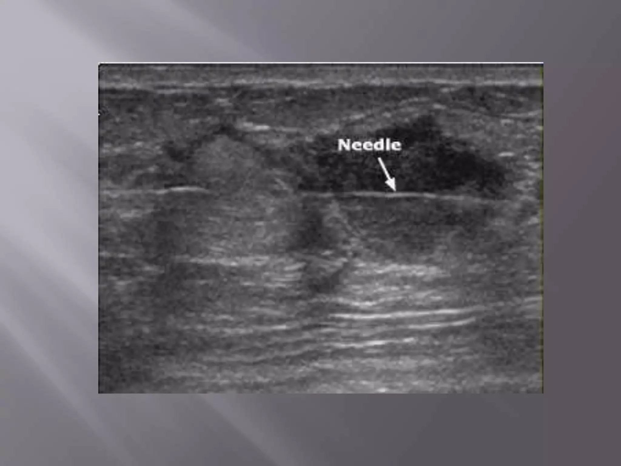 Ultrasound guided interventional procedure | PPTX