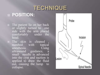 Ultrasound guided interventional procedure | PPTX
