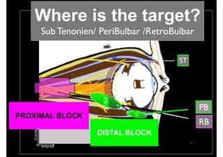 Ultrasound guided Ophtalmic block 2017 | PDF