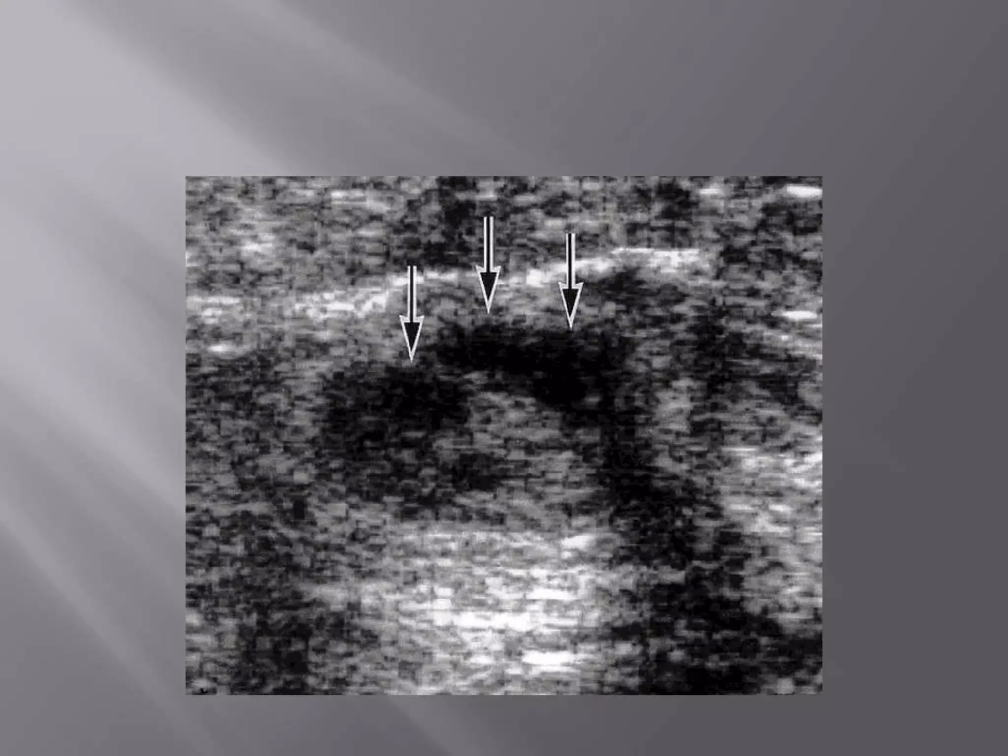Ultrasound guided procedures | PPTX