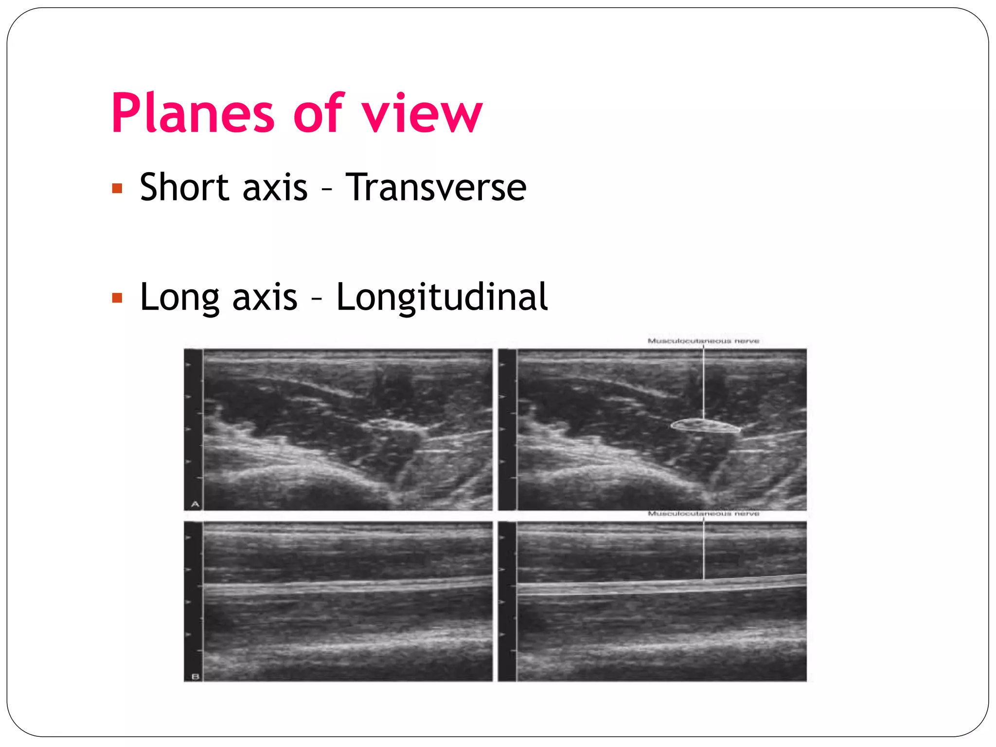 Ultrasound guided regional anesthesia.pptx