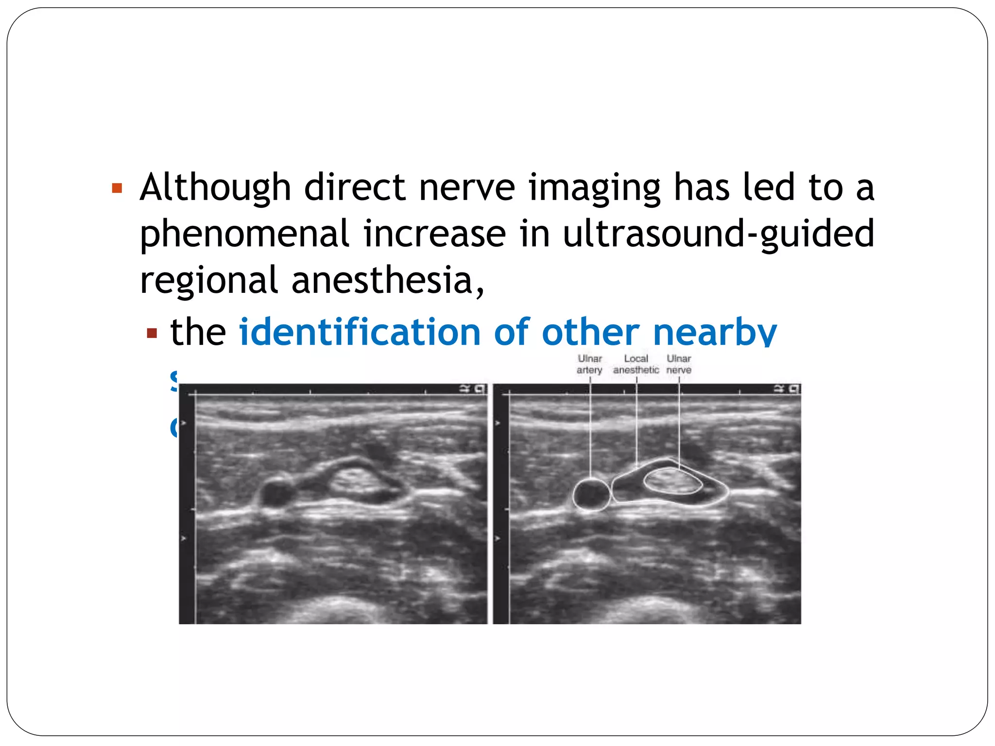 Ultrasound guided regional anesthesia.pptx