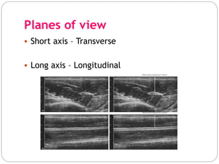 Ultrasound guided regional anesthesia.pptx