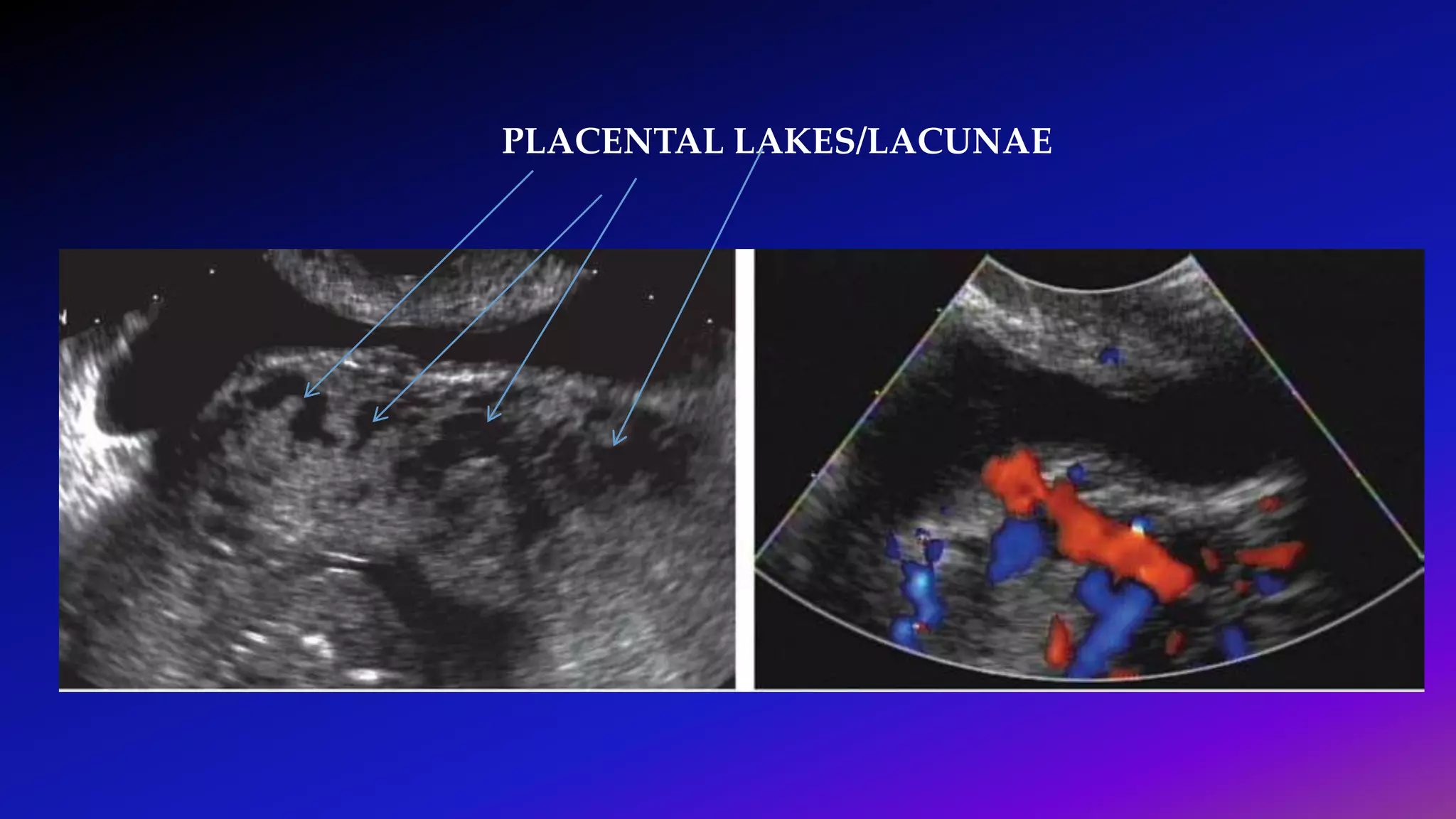 Ultrasound Imaging of Placenta | PPTX