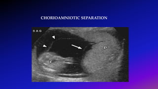 Ultrasound Imaging of Placenta | PPTX
