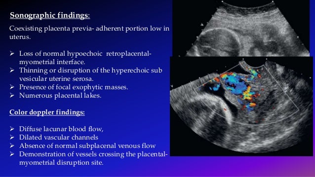 Ultrasound Imaging of Placenta