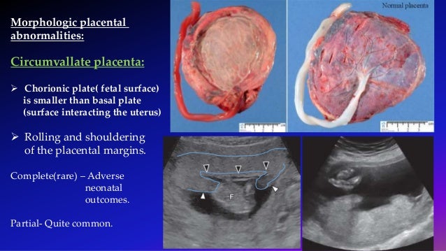 Ultrasound Imaging of Placenta