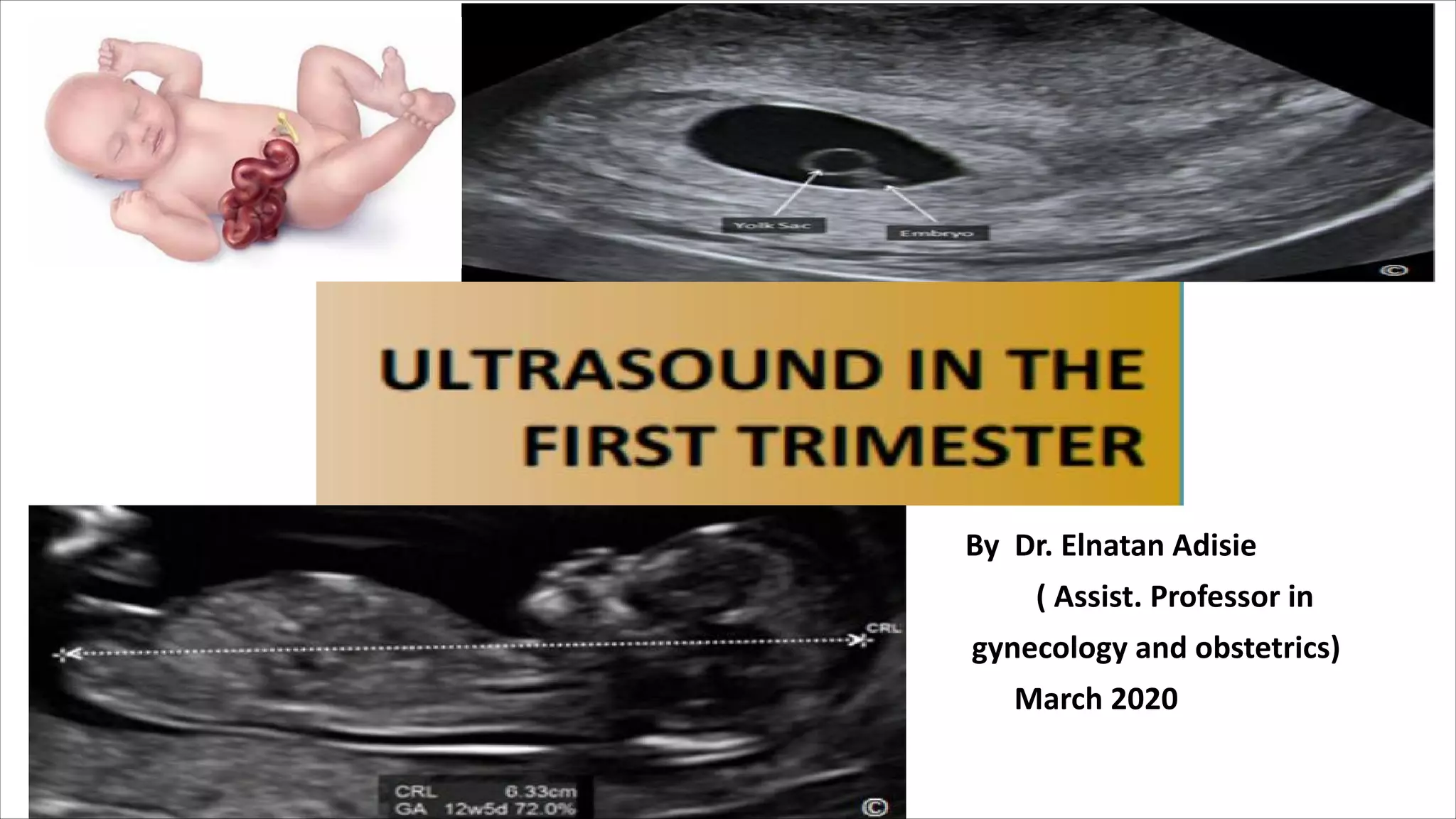 ultrasound in 1st TM.pdf