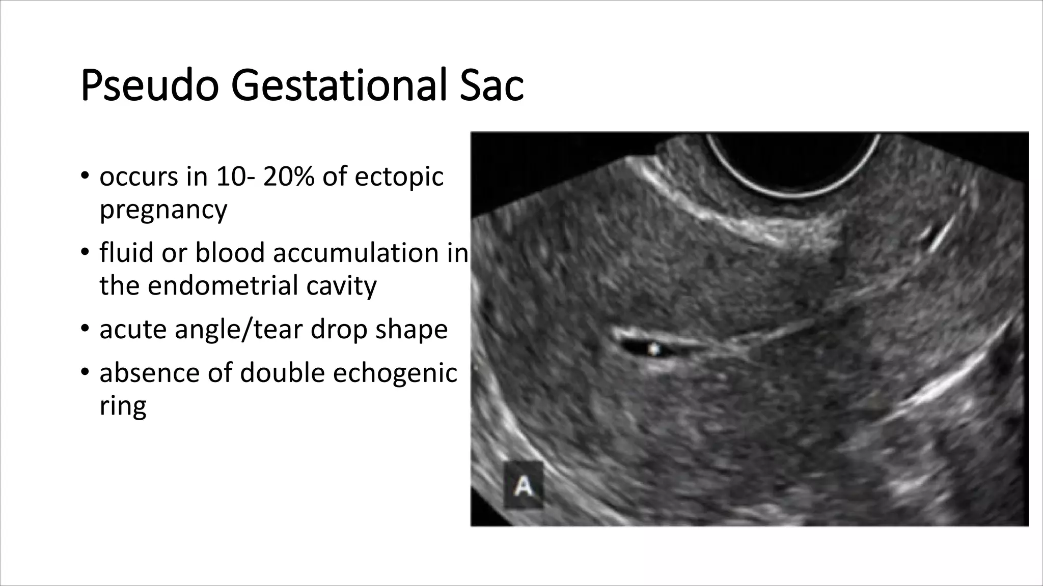 ultrasound in 1st TM.pdf