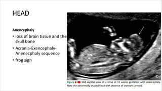 ultrasound in 1st TM.pdf