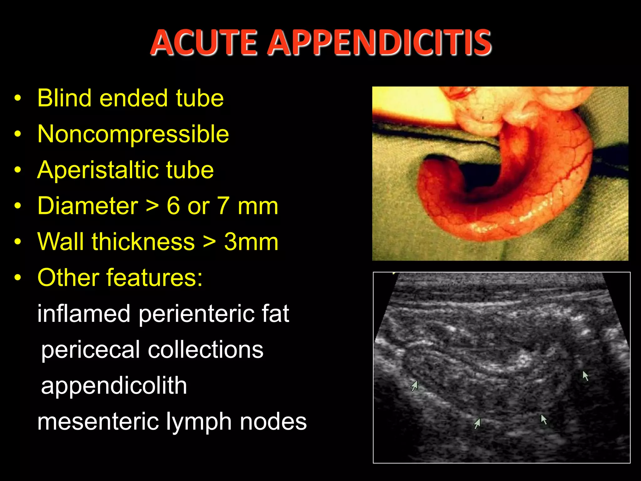 Ultrasound in acute abdominal pain | PDF