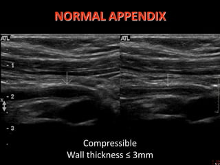 Ultrasound in acute abdominal pain | PDF