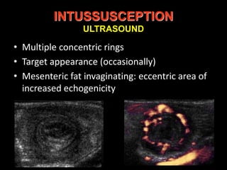 Ultrasound in acute abdominal pain | PDF