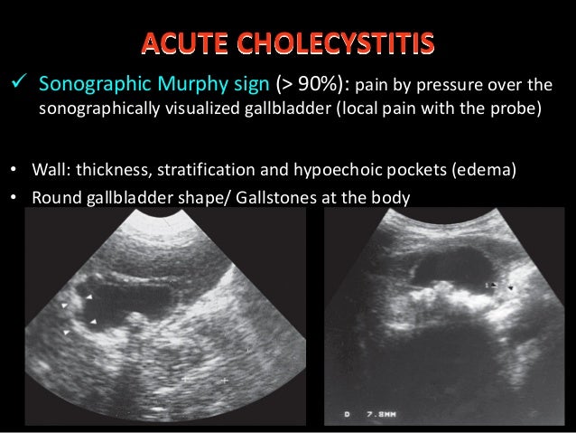 Ultrasound in acute abdominal pain