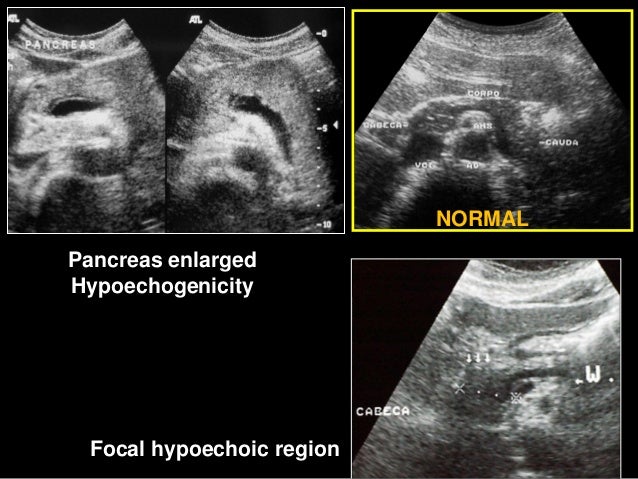 Ultrasound in acute abdominal pain