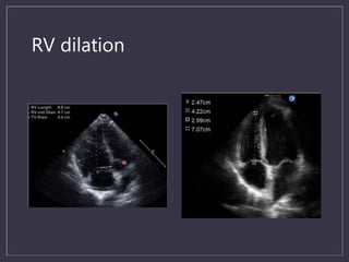 Ultrasound in cardiac arrest | PPTX
