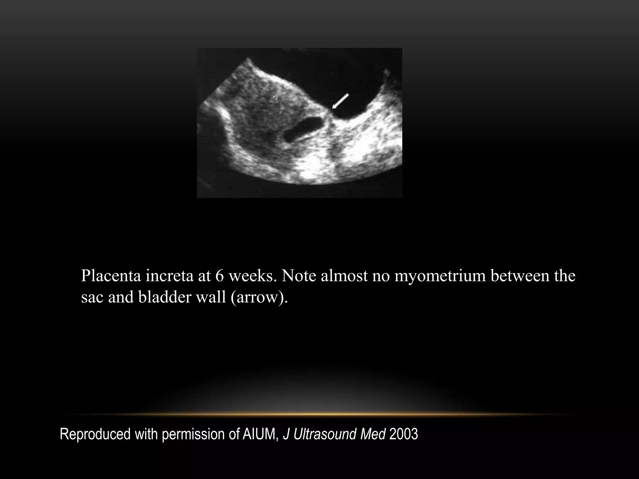Ultrasound in diagnosis of placental invasion | PPTX