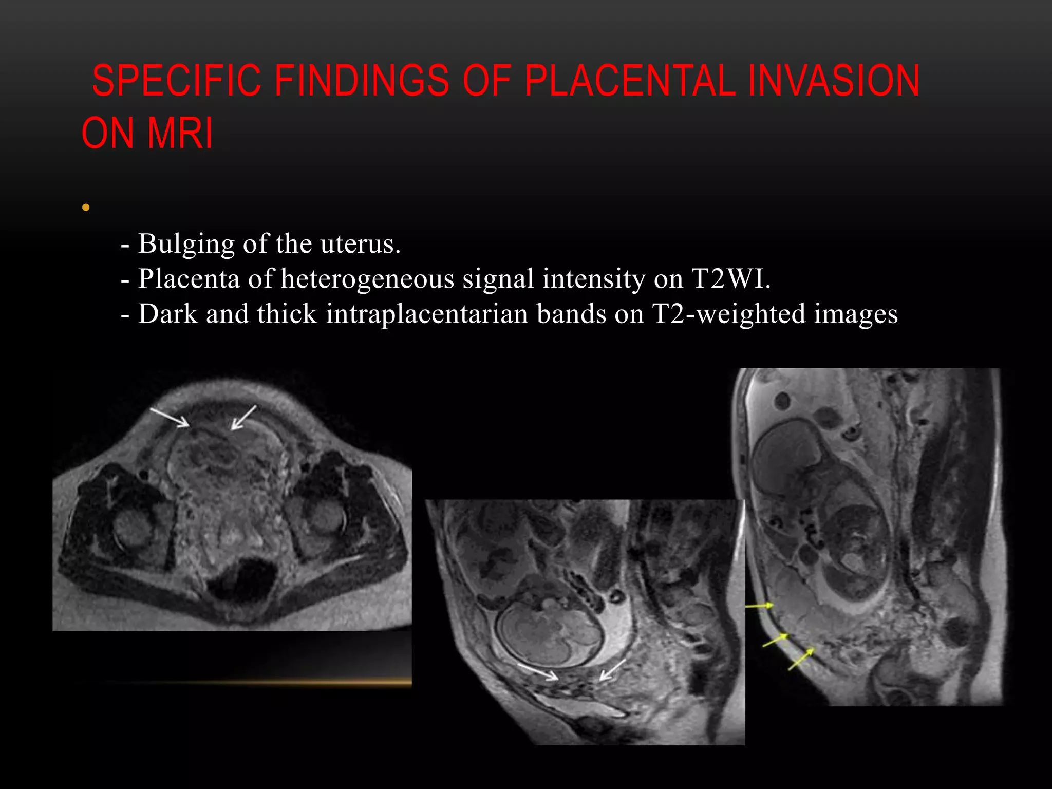 Ultrasound in diagnosis of placental invasion | PPTX