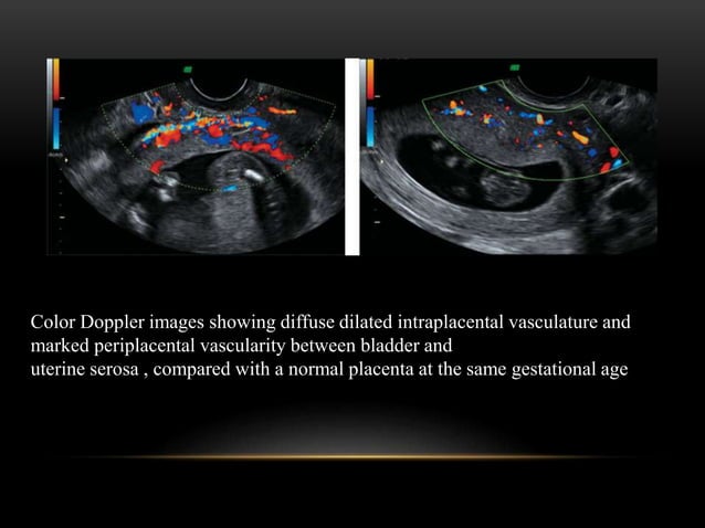 Ultrasound in diagnosis of placental invasion | PPTX | Pregnancy ...