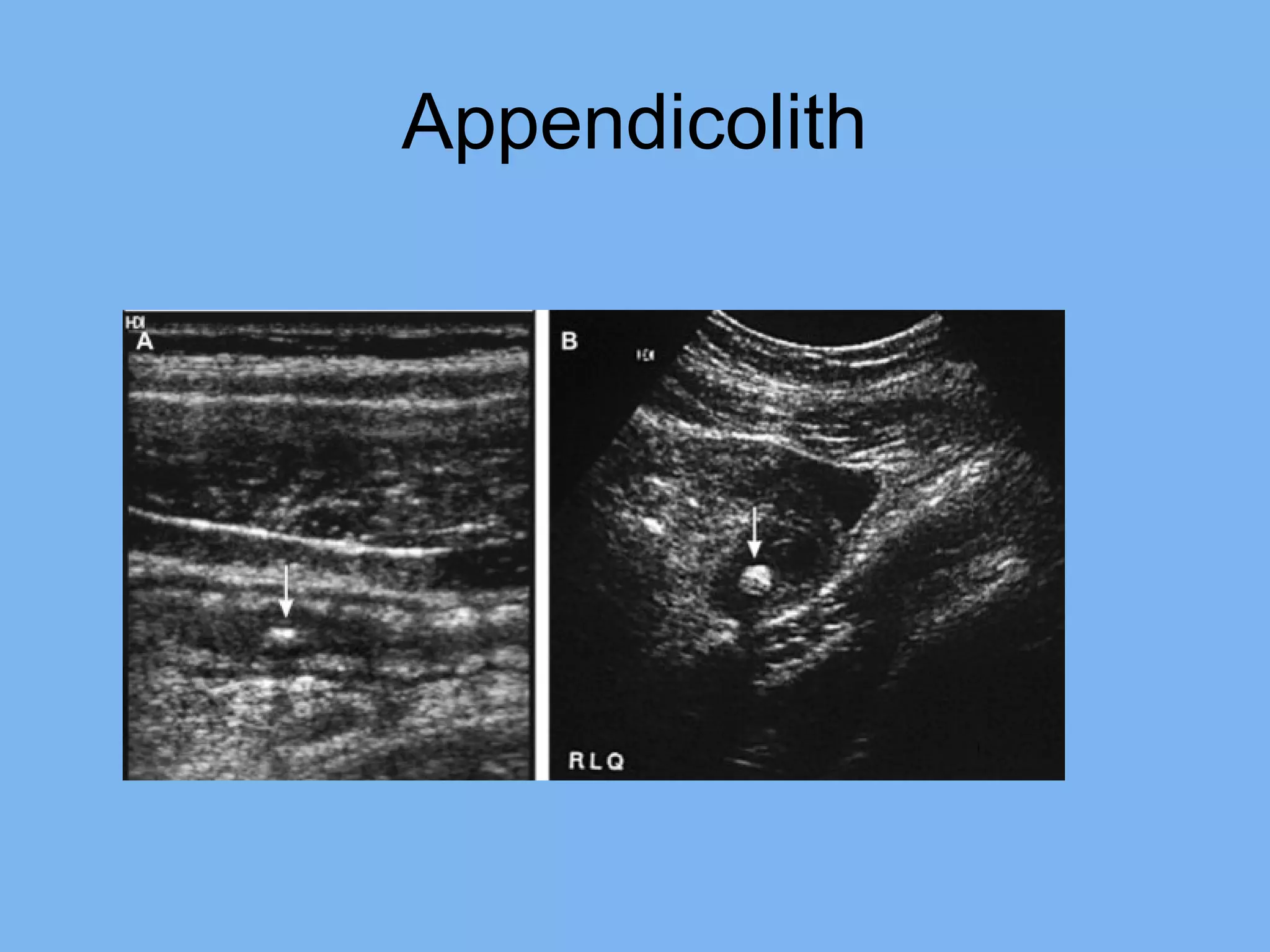 Ultrasound in abdominal emergencies | PPT