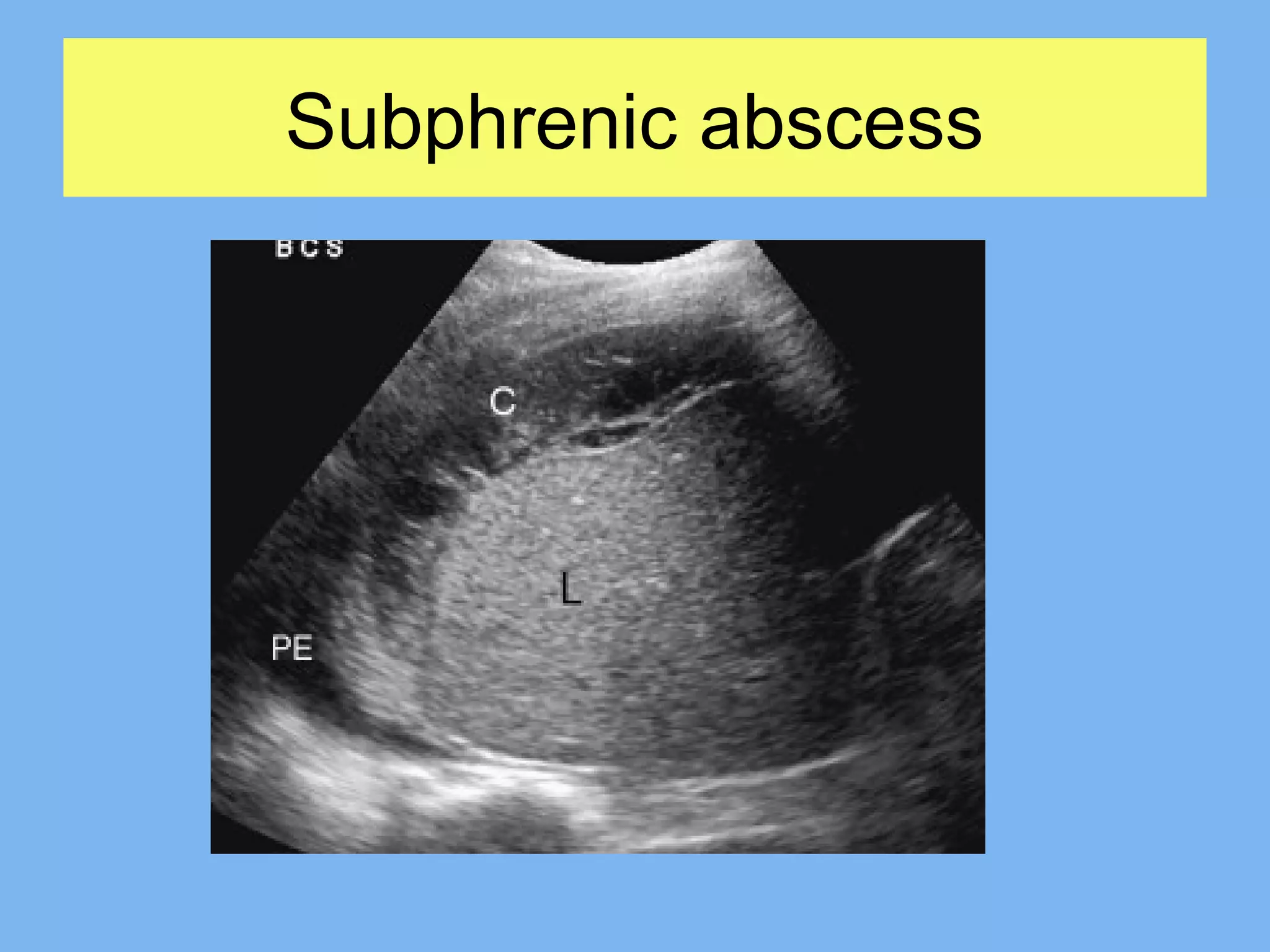 Ultrasound in abdominal emergencies | PPT